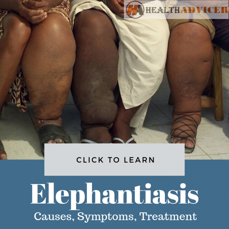 Elephantiasis Causes Picture Symptoms And Treatment