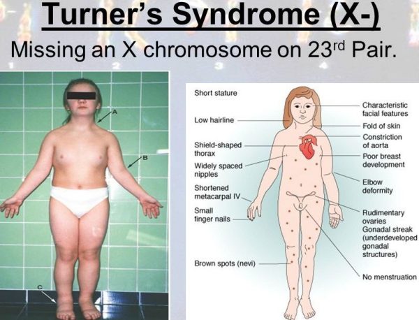 Turner Syndrome Causes Picture Symptoms And Treatment