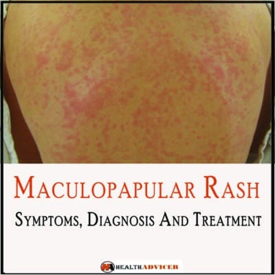 Maculopapular Rash: Causes, Symptoms And Treatment